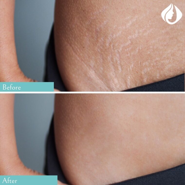Stretch Marks Removal Toronto, North York, Markham | La Vitalité Med Spa