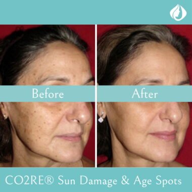CO2RE® Laser Skin Resurfacing Toronto, North York, Markham | La ...